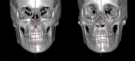 Does Facial Skeletal Asymmetries Have The Same Components In Class I