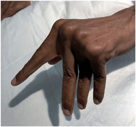 An Intrinsic Plus Contracture In A Patient With PD Download