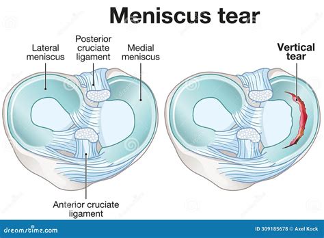 Meniscus Tears Anatomy Medically Illustration Stock Photography CartoonDealer Com 309185642