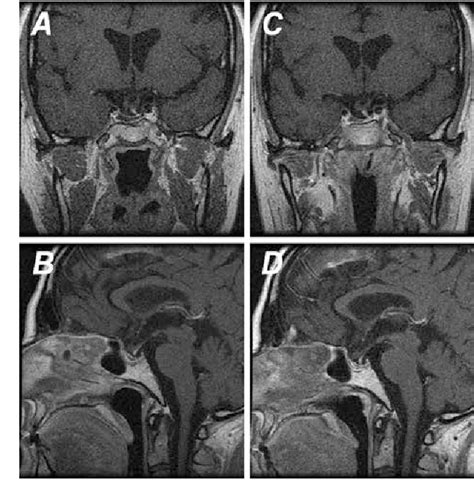 Figure 1 From Spontaneous Regression Of Non Functioning Pituitary