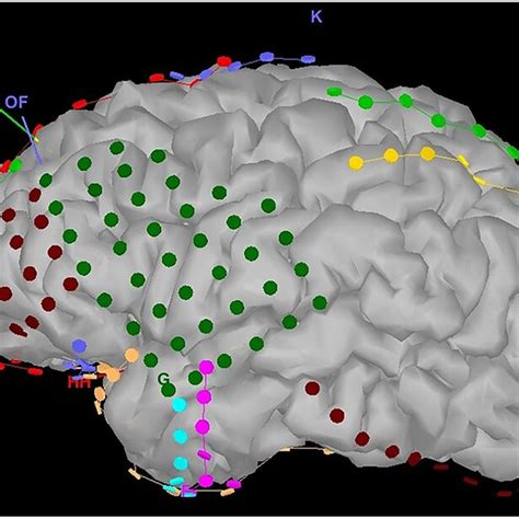 Reconstruction Of Electrodes On A Mesh Of A Preimplantation 3 D Download Scientific Diagram