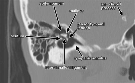 Scutum Temporal Bone