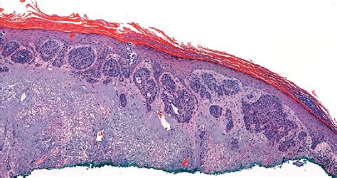 Squamoid Eccrine Ductal Carcinoma Cytologically Atypical Squamoid Download Scientific Diagram