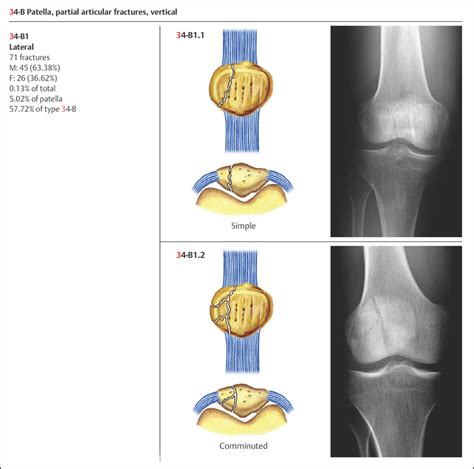 Fractures Of Other Locations Musculoskeletal Key Fractures Of Other Locations Musculoskeletal Key