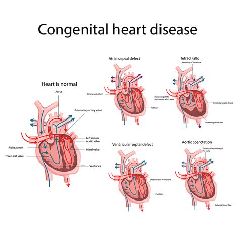 Congenital What Is Congenital Heart Defect Hot Sex Picture