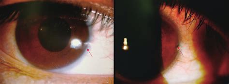 The Anterior Segment Of The Patients Right Eye Was Photographed A A