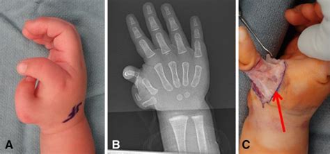 Classifications In Brief The Wassel Classification For Radial Polydactyly Pmc