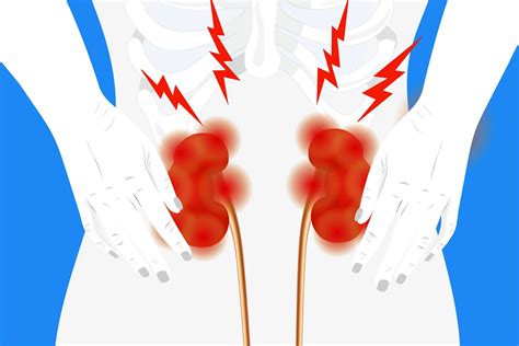 What Is Scleroderma Renal Crisis Symptoms Causes Treatment