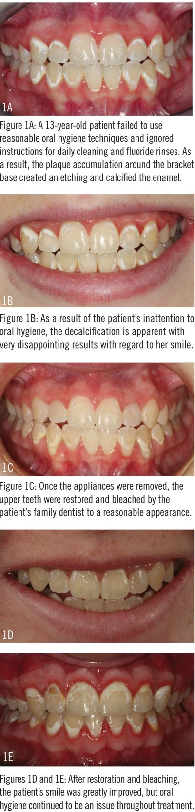 Bad Braces Results