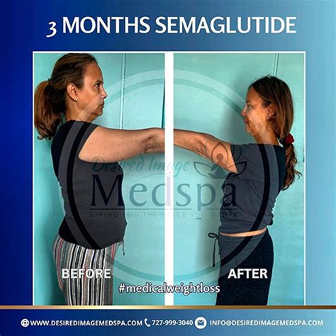Semaglutide Before And After Photos Weight Loss Results