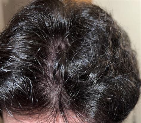 Confirmation Of Diffuse Thinning Viable Solutions R Tressless