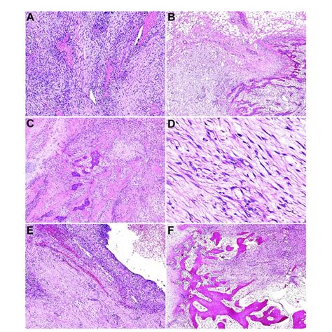 Histopathologic Characteristics Of Myositis Ossificans And Download Scientific Diagram