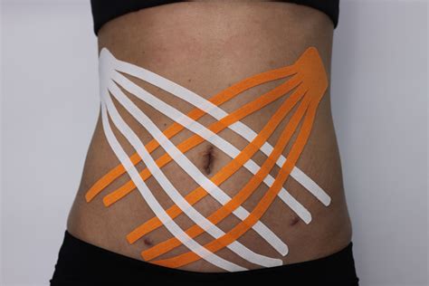 Тейпирование на живот для похудения схемы до и после