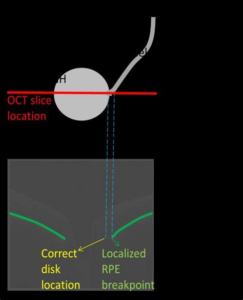 Improvement Of Rpe Localization By Vessel Information Iii Results To