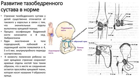 Врожденный вывих бедра презентация онлайн