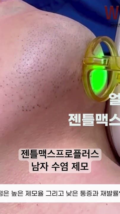 젠틀맥스프로플러스 남자얼굴 전체 수염 제모 20240522 수원 원스의원 수원남자제모 수원수염제모 남자제모 수염제모 젠틀맥스프로플러스 레이저제모