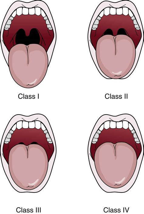Assessment And Management Of The Airway Anesthesia Key