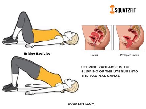 Pelvic Floor Exercises For Uterine Prolapse Infoupdate Org