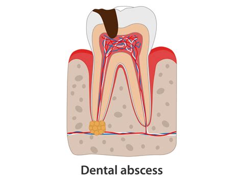 How Long Does It Take For An Abscess To Drain On Its Own