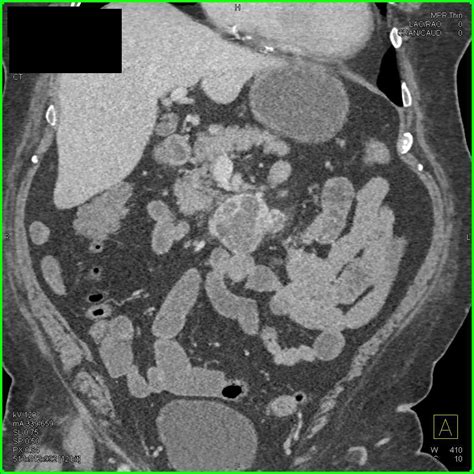 Duodenal Gist Tumor Small Bowel Radiology Case Studies Ctisus Ct
