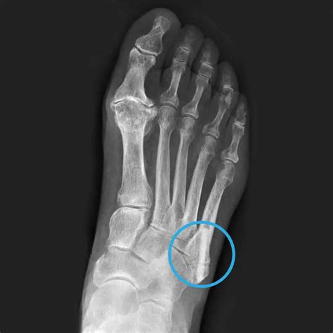 Metatarsal Fracture Appearance And Symptoms