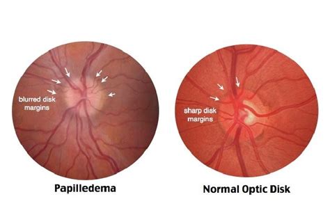 Normal Optic Nerve Vs Papilledema