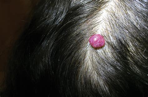 Growing Scalp Nodule Mdedge