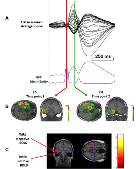 A Combined Eeg Source Imaging And Fmri For The