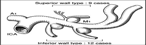 Saccular Aneurysms Of The Proximal M1 Segment Of The Middl Saccular Aneurysms Of The Proximal M1 Segment Of The Middl