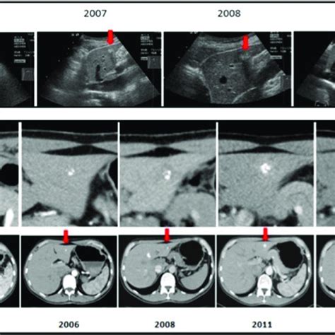 A Metastatic Lesion In Segment 3 Of The Liver Of A Single Patient In Download Scientific