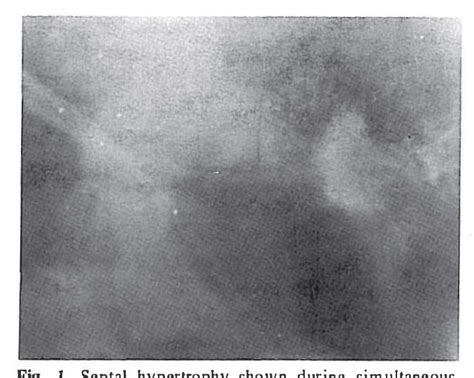 Figure 1 From Diffuse Coronary Arterial Ectasia With Hypertrophic