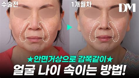 안면거상 하안검의 놀라운 변화 안면거상 이마거상 하안검 반거상 디엠성형외과 Youtube
