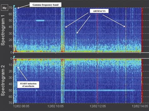 Left 1 And Right 2 Spectrogram Of The Frontal Electroencephalogram Download Scientific