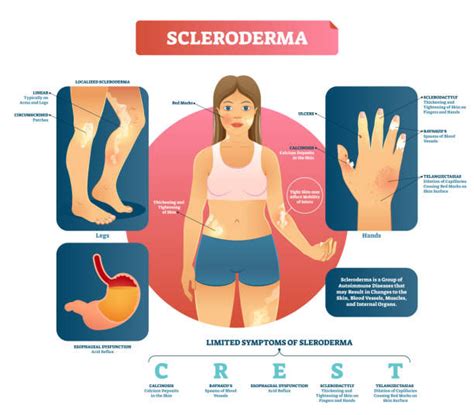 Navigating Scleroderma A Personal Path To Medicine And Awareness