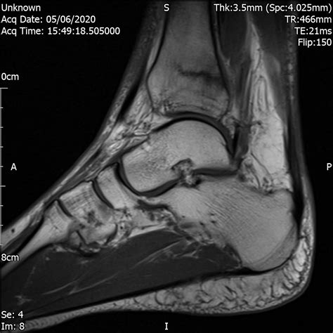 Undisplaced Fracture Distal Tibial Metaphysis Cases Home