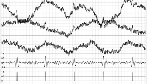 convolution correlation algorithm of qrs complex detection tredex