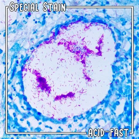 Special Stain Acid Fast Pathology And Ponies