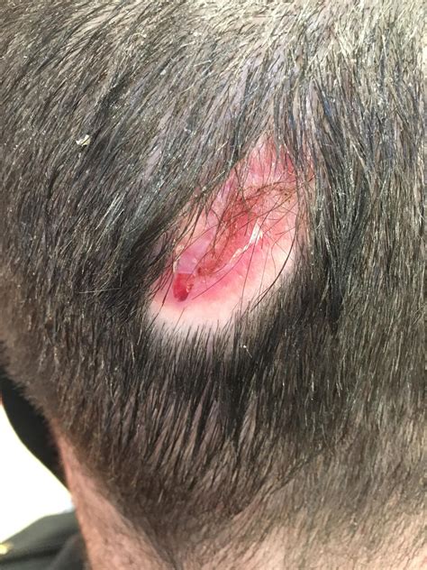 Is This Possibly Scabies Hair Loss And Marks On Scalp Very Worried R Scabies