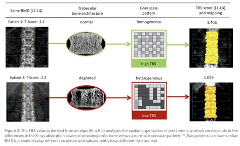 Trabecular Bone Scoring What Is It News Onewelbeck