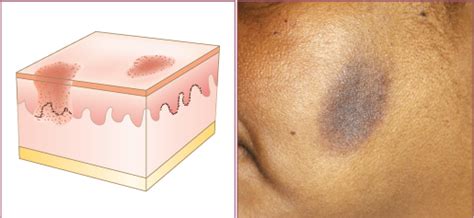 Dermatologia Classificação Das Lesões Elementares Da Pele