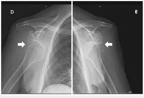 Shoulder Radiographs Of Bilateral Symmetric Anterior Shoulder Download Scientific Diagram