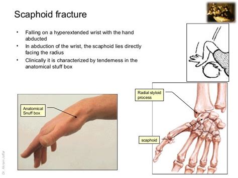 Imaging Anatomy Scaphoid Fracture
