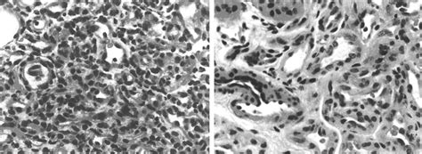 A Proliferative Hemangioma Consisting Of Masses Of Proliferating