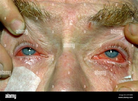 Sclera Disorders
