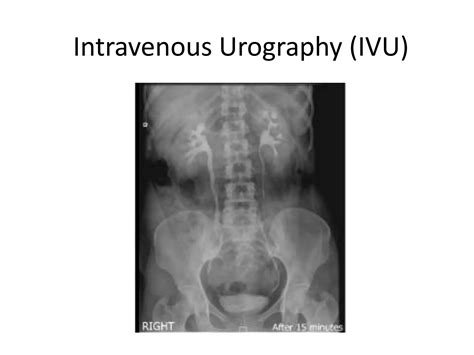 Intravenous Urography Ivu Radiological Procedure Ppt