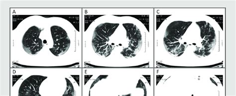 Ct Scan Showing Normal Lung Tissue In The Patient 1 Year Previously