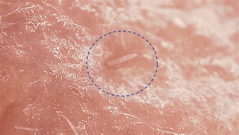 Bizarre Mating Habits Of The Mites That Live On Your Face Revealed IFLScience