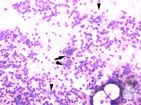 Figure A Bone Marrow Aspirate Smear 20x Giemsa Stain Showing Blasts
