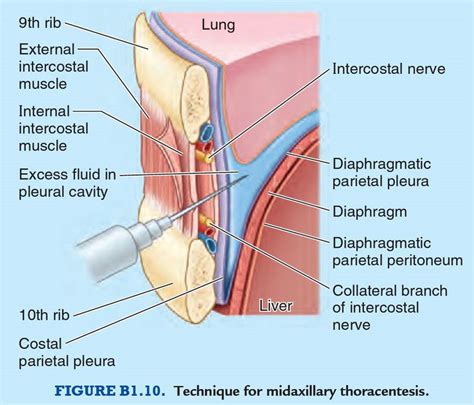 Thoracentesis Anatomy Thoracentesis Erin M Debiasi Jonathan