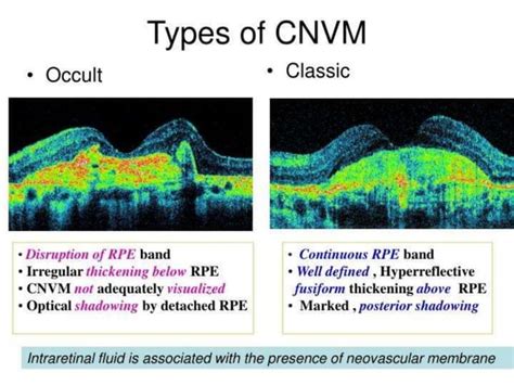 Choroidal Neovascular Membranes Cnvm Pptx